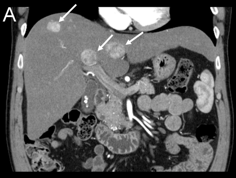 Hepatic Artery Embolization | UCSF Surgical Oncology